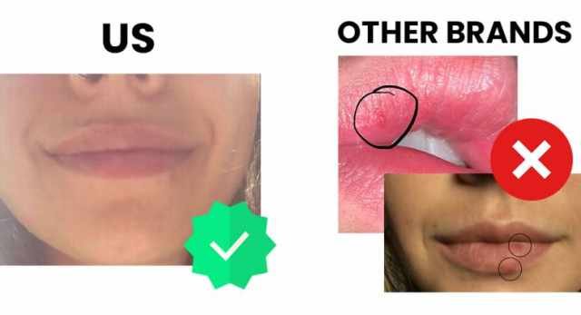 Herpes Solution - Blisterol | Official Website